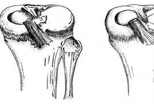 The Effectiveness of Meniscus Special Tests